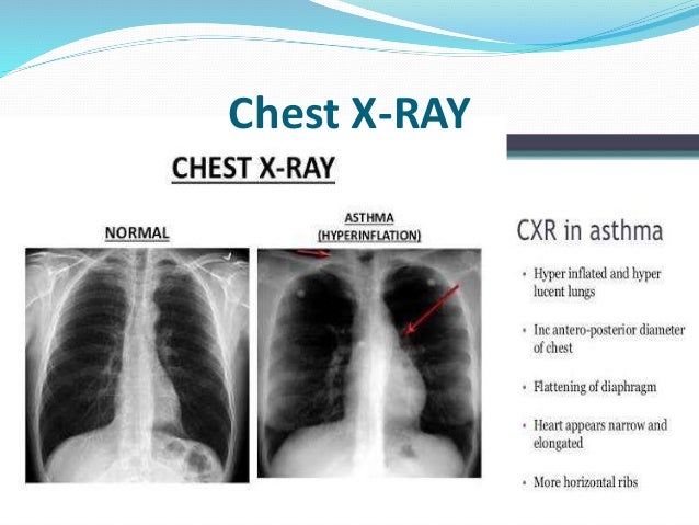 Asthma Chest X Ray Images Photos Mungfali