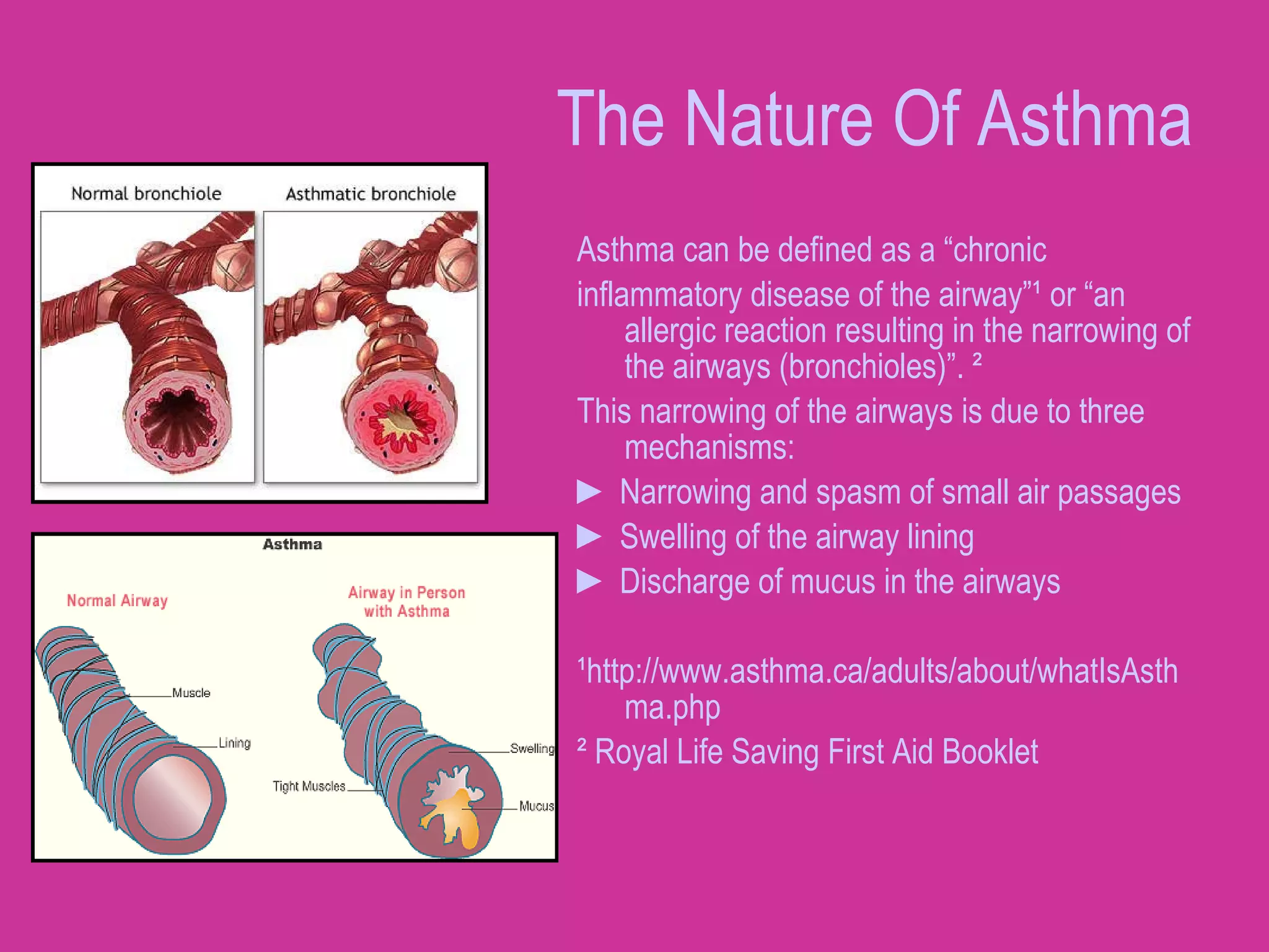 Asthma | PPT