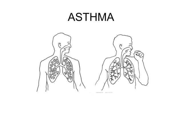 Asthma lecture | PPTX | Lung and Respiratory Health | Diseases and ...