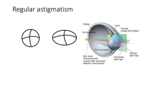 Astigcorrection | PPTX