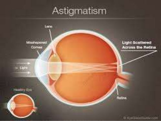 Astigmatism