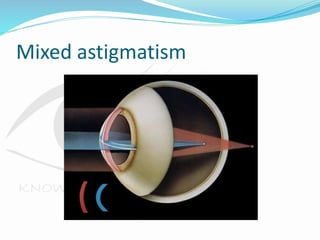 Astigmatism | PPTX