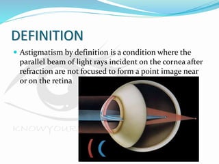 Astigmatism | PPTX