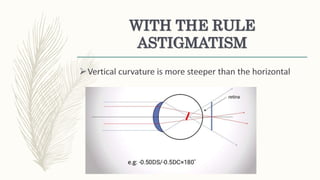 Astigmatism | PPTX