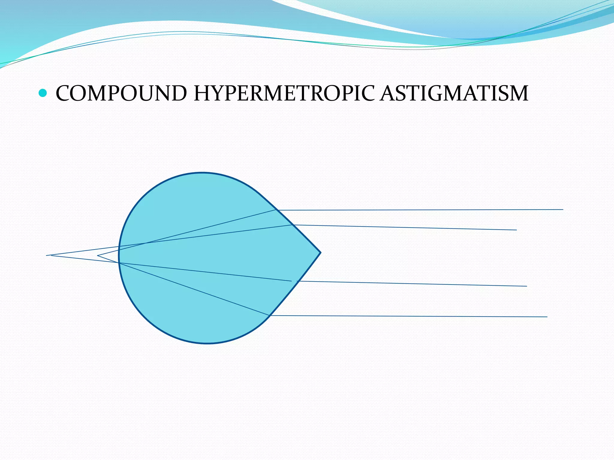 Astigmatism | PPTX | Eye and Vision Conditions | Diseases and Conditions