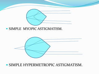 Astigmatism | PPTX | Eye and Vision Conditions | Diseases and Conditions