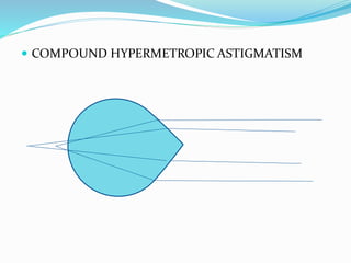 Astigmatism | PPTX | Eye and Vision Conditions | Diseases and Conditions