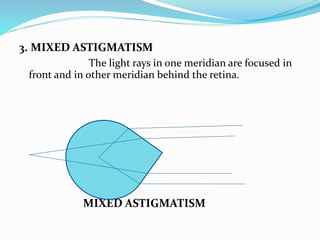 Astigmatism | PPTX | Eye and Vision Conditions | Diseases and Conditions