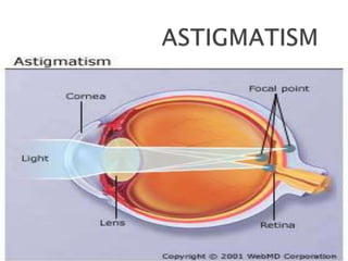 Astigmatism | PPT