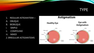 Astigmatism | PPTX