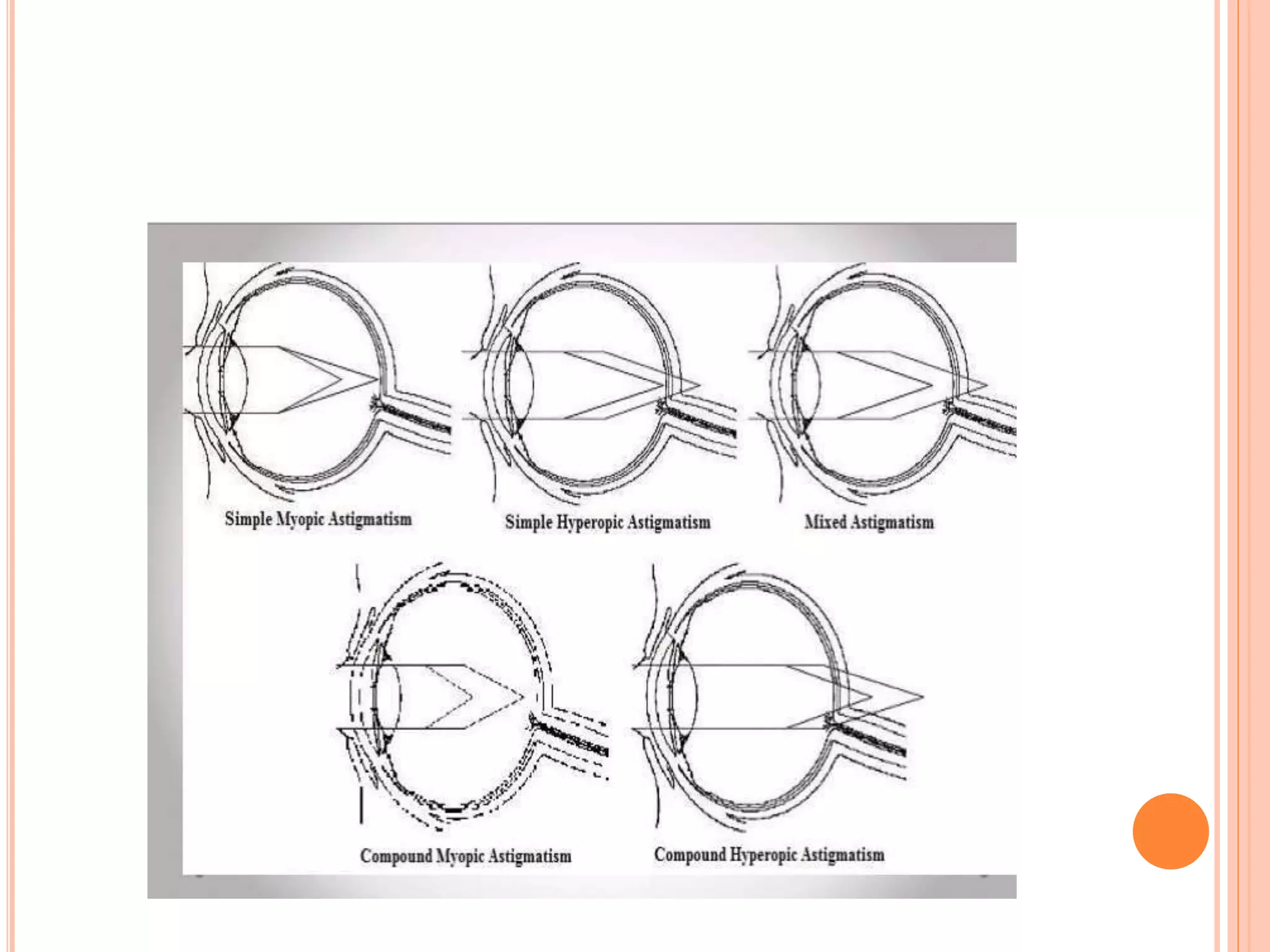Astigmatism | PPTX