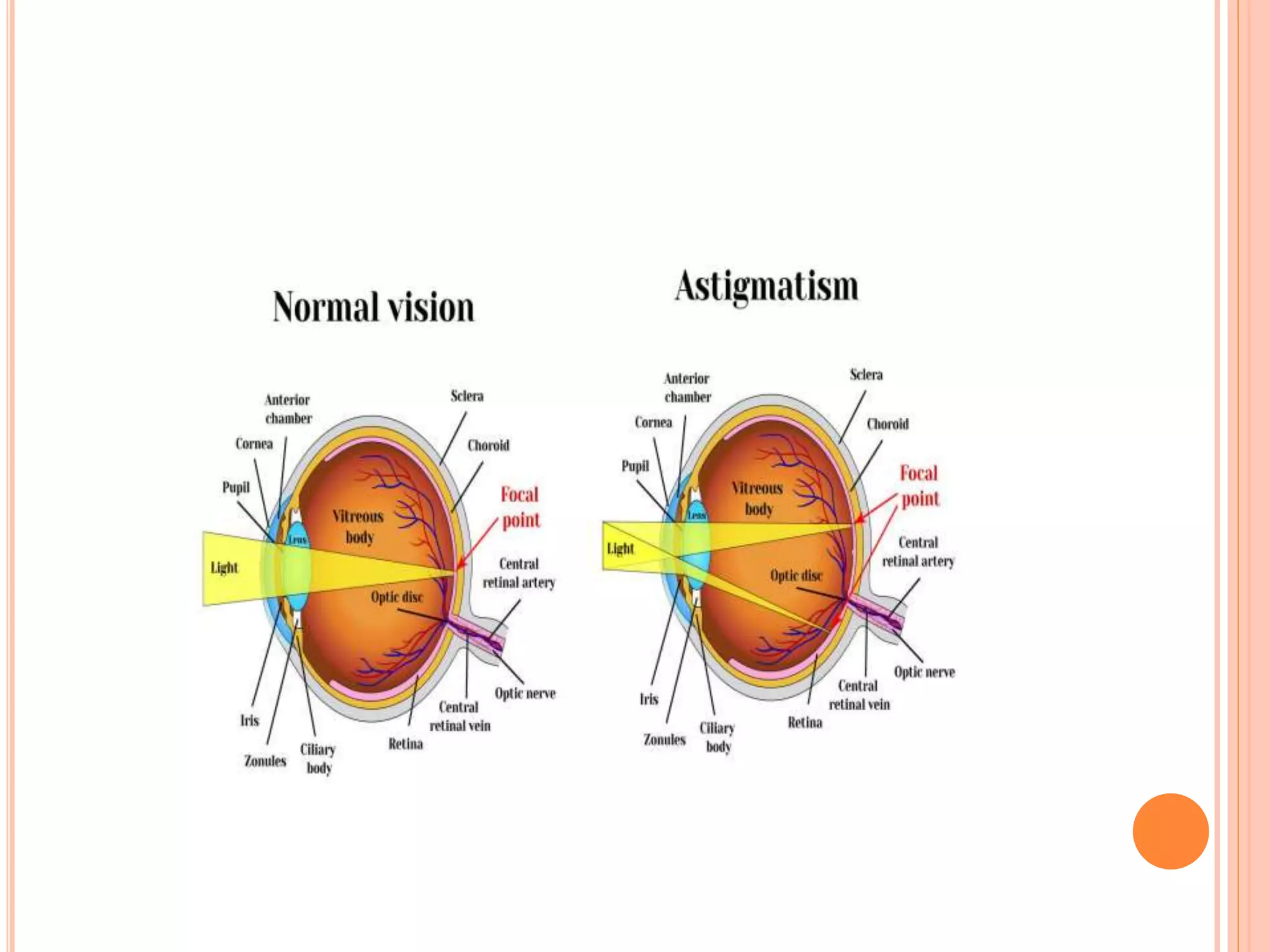 Astigmatism | PPT