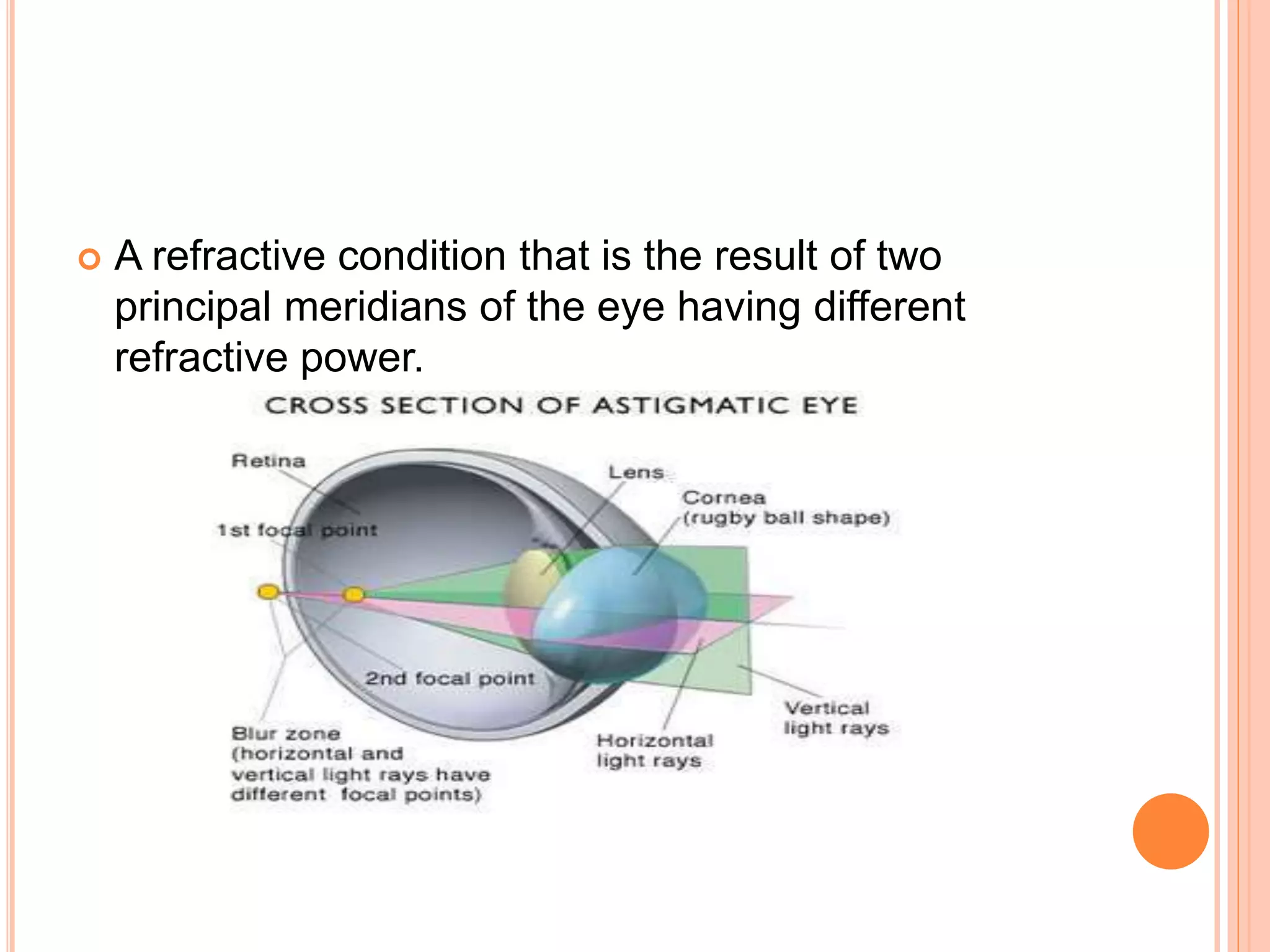 Astigmatism | PPTX