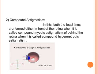 Astigmatism | PPT