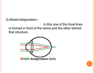 Astigmatism | PPT