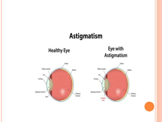 Astigmatism | PPT