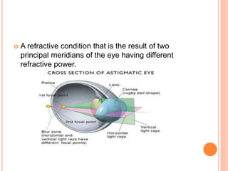Astigmatism | PPT
