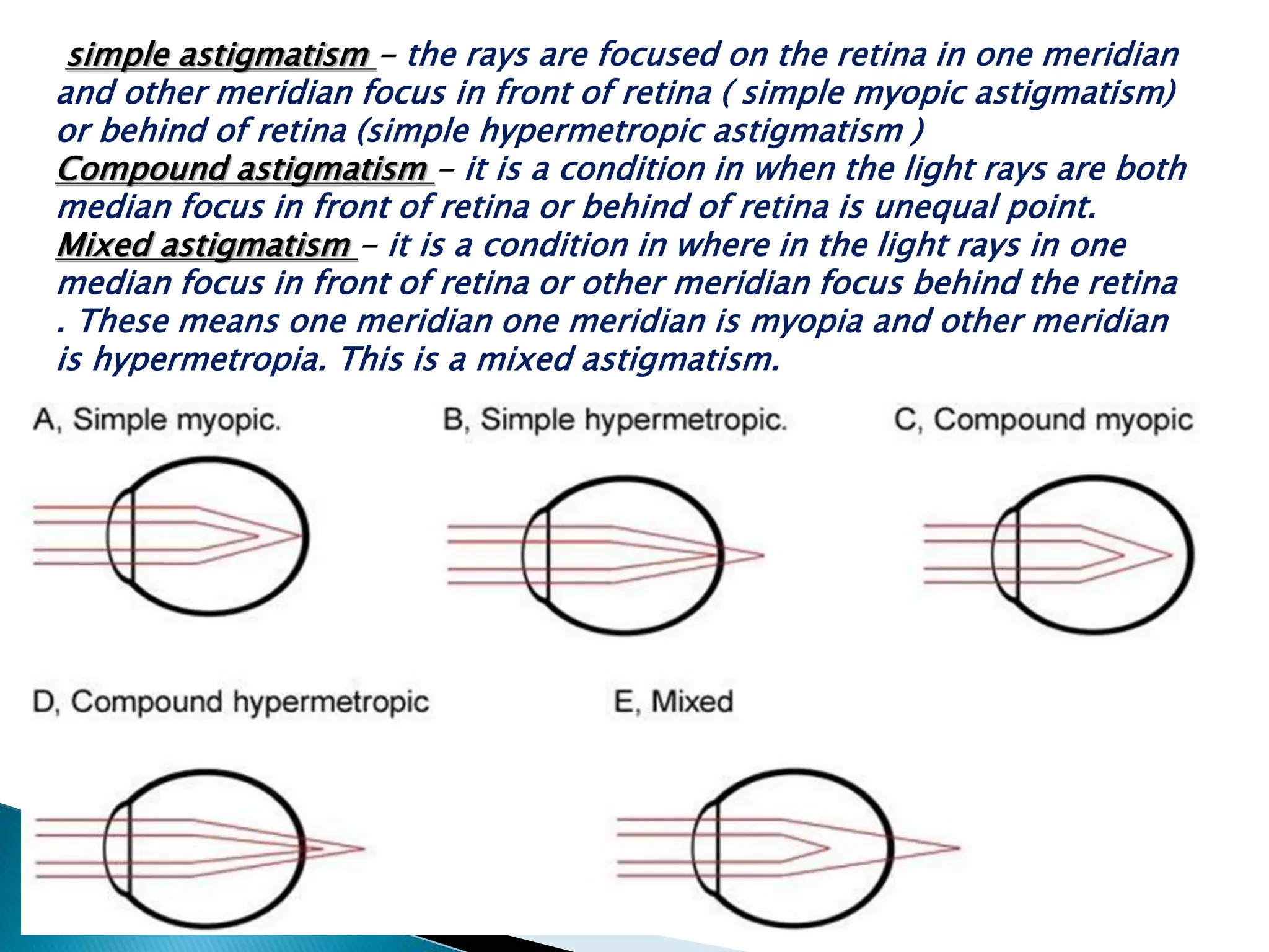 Astigmatism | PPTX