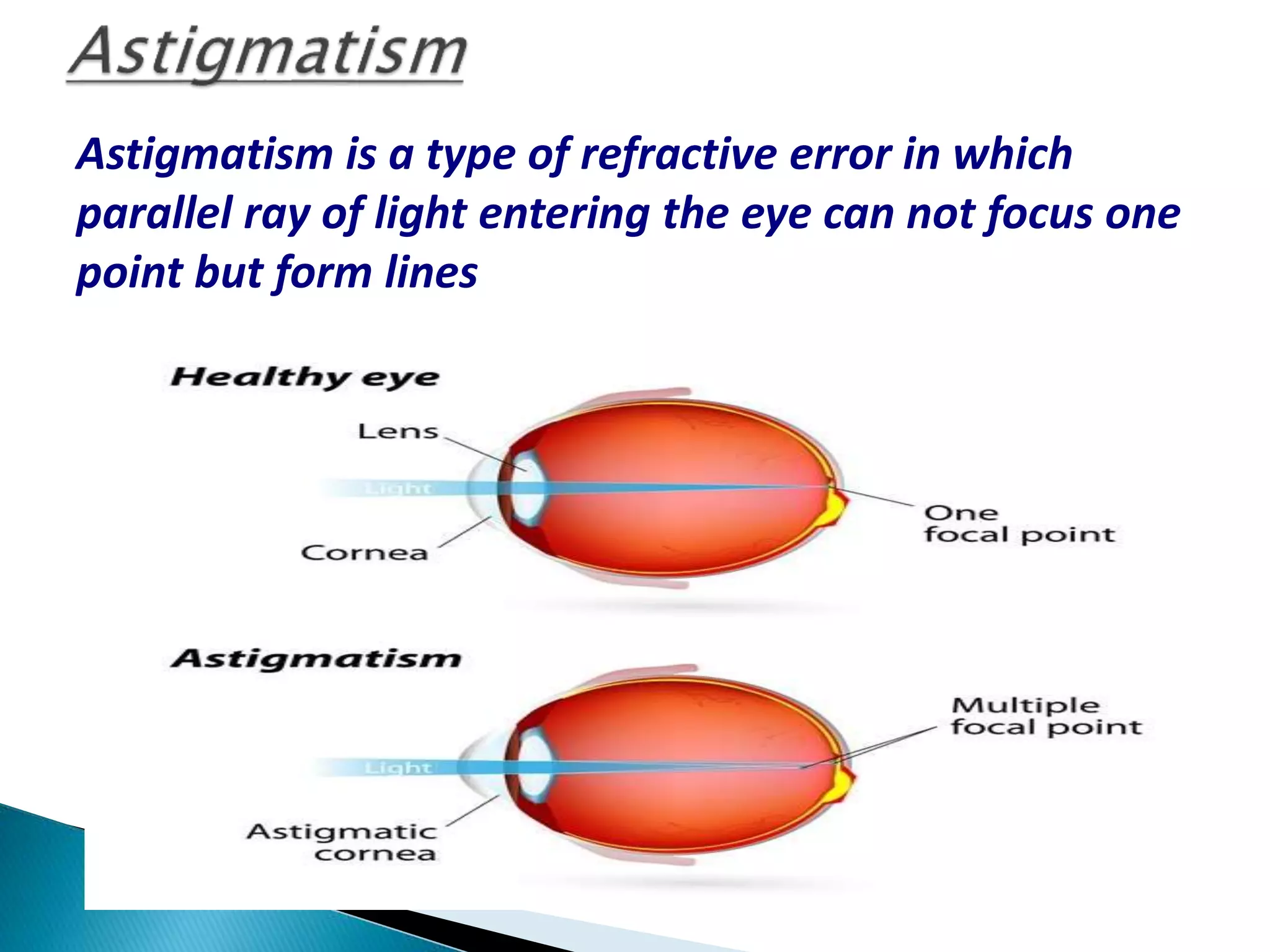 Astigmatism | PPTX