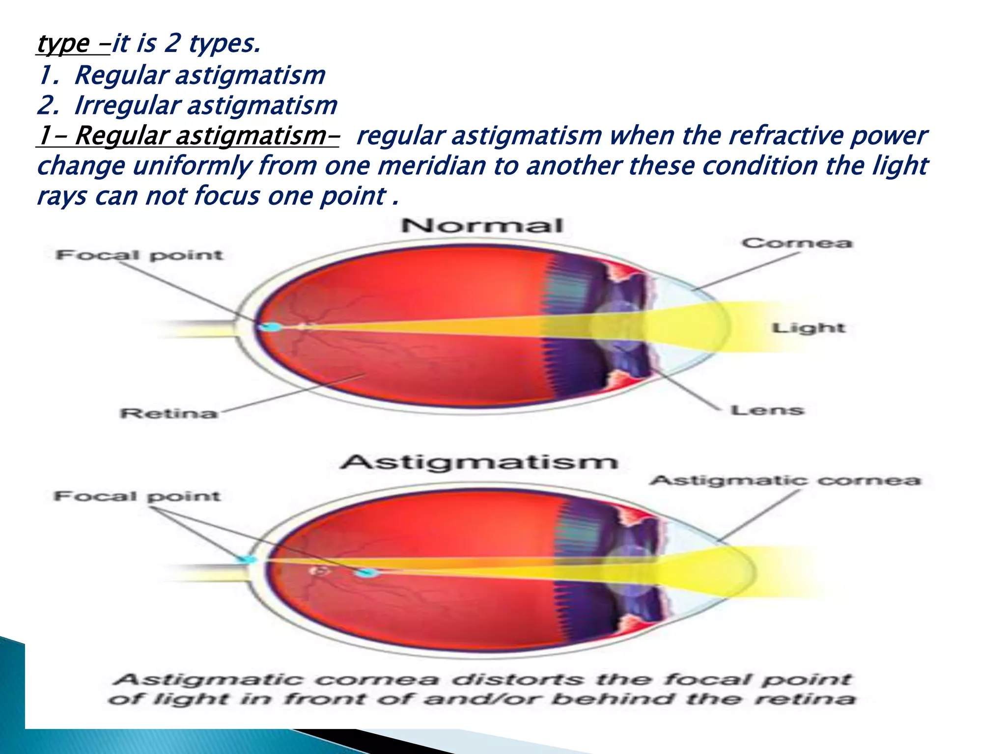 Astigmatism | PPTX