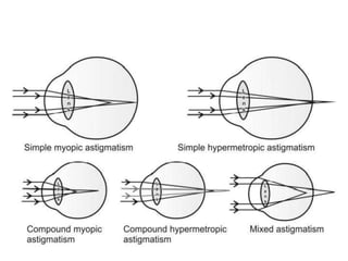 Astigmatism | PPTX