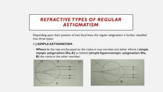 Astigmatism | PDF