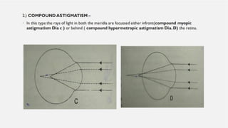 Astigmatism | PDF
