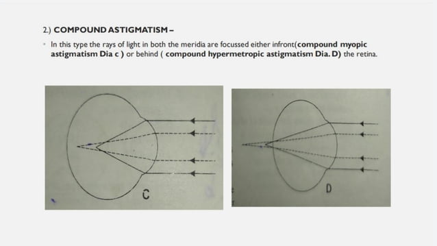 Astigmatism | PPT