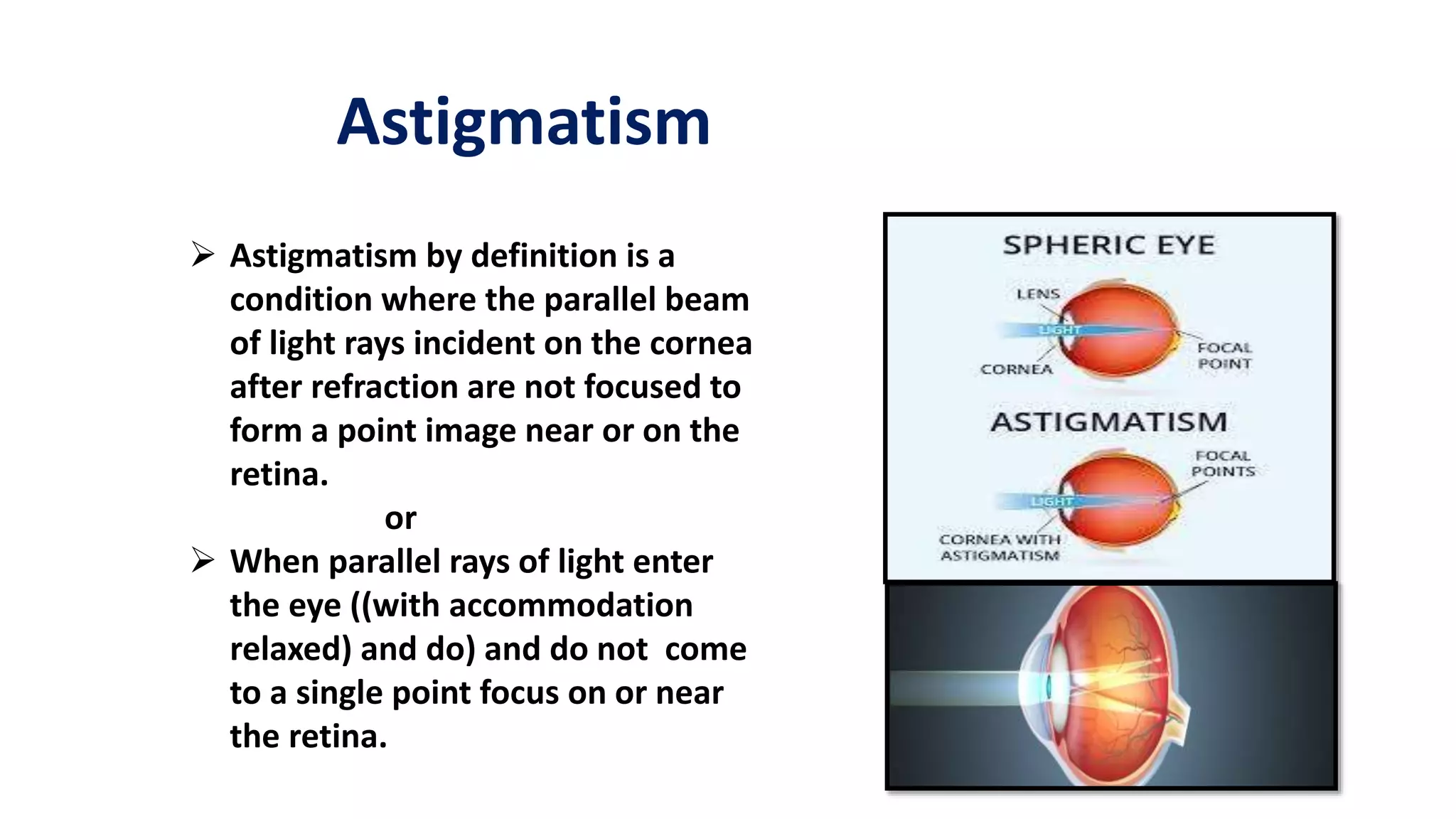 Astigmatism ppt | PPTX