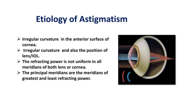 Astigmatism ppt | PPT