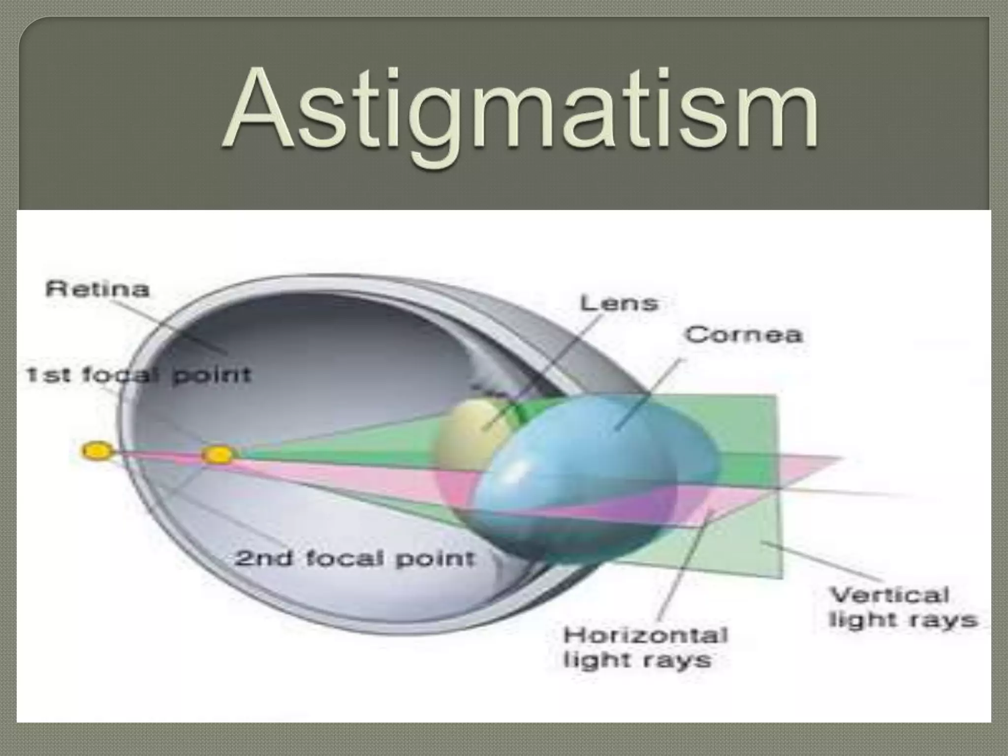 Astigmatism.pptx