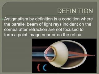 Astigmatism.pptx