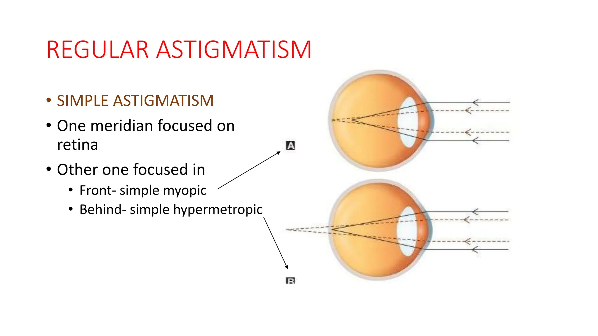 Astigmatism, Classification, Sturm's conoid | PPTX