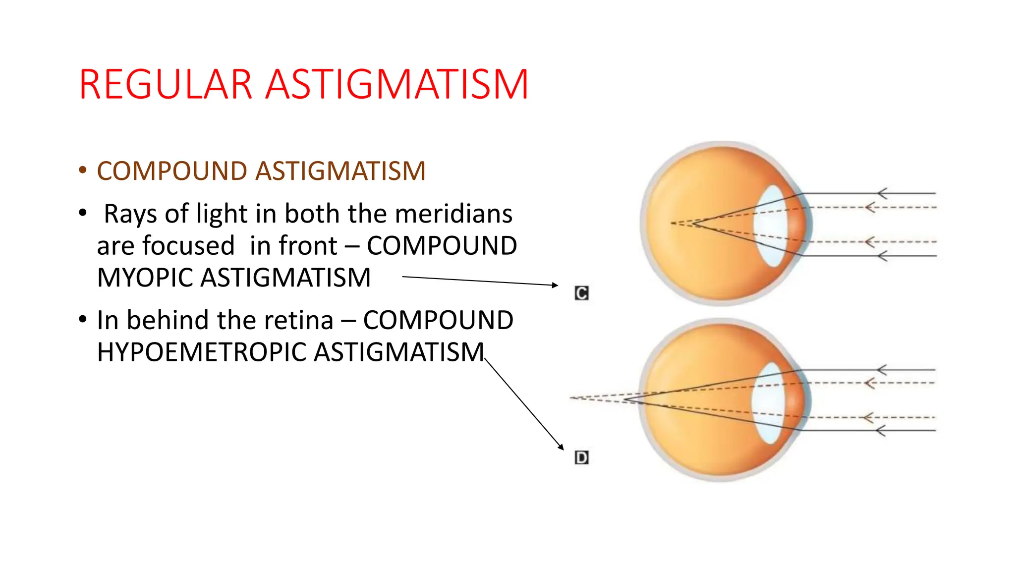 Astigmatism, Classification, Sturm's conoid | PPTX