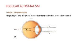 Astigmatism, Classification, Sturm's conoid | PPTX