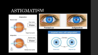 ASTIGMATISM.pptx