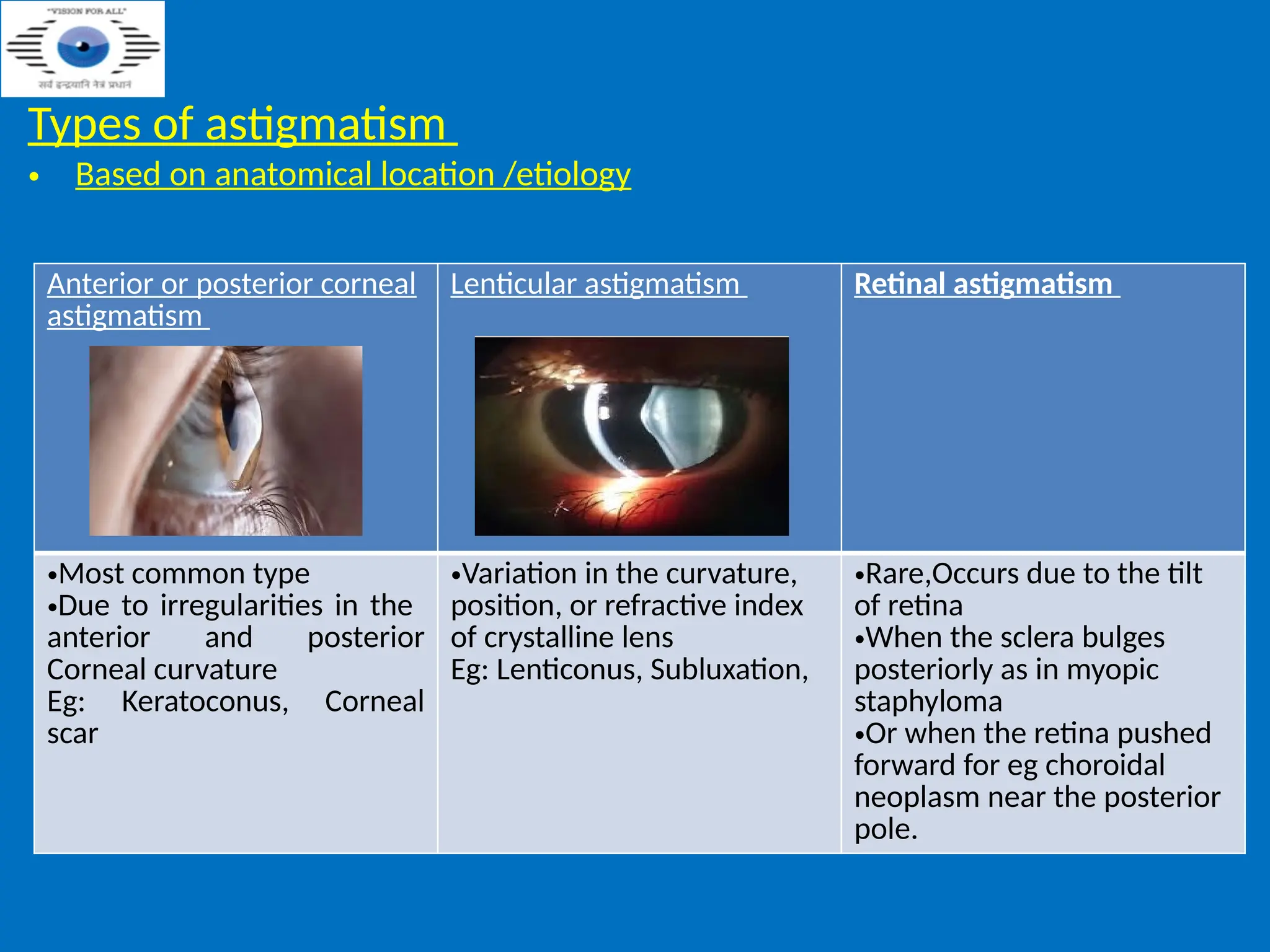 ASTIGMATISM.pptx........................ | PPTX