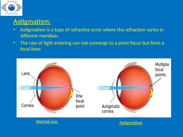 ASTIGMATISM.pptx........................ | PPTX