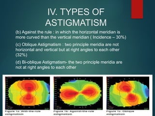 Astigmatism-Types and its Management.pptx