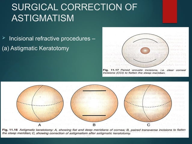 Astigmatism-Types and its Management.pptx