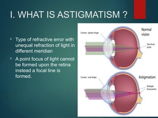 Astigmatism-Types and its Management.pptx