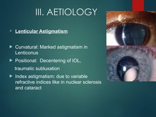 Astigmatism-Types and its Management.pptx