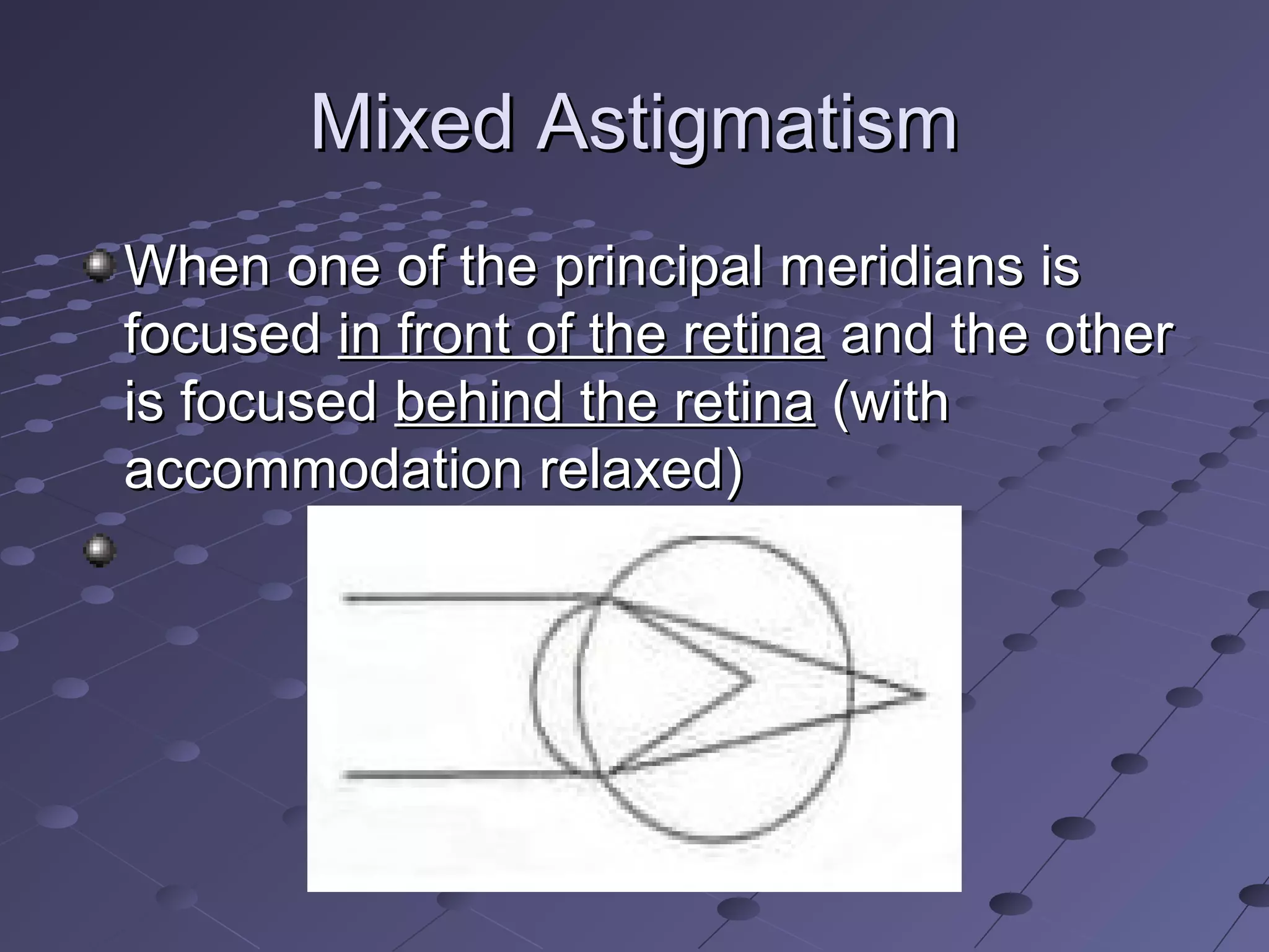 Astigmatism | PDF