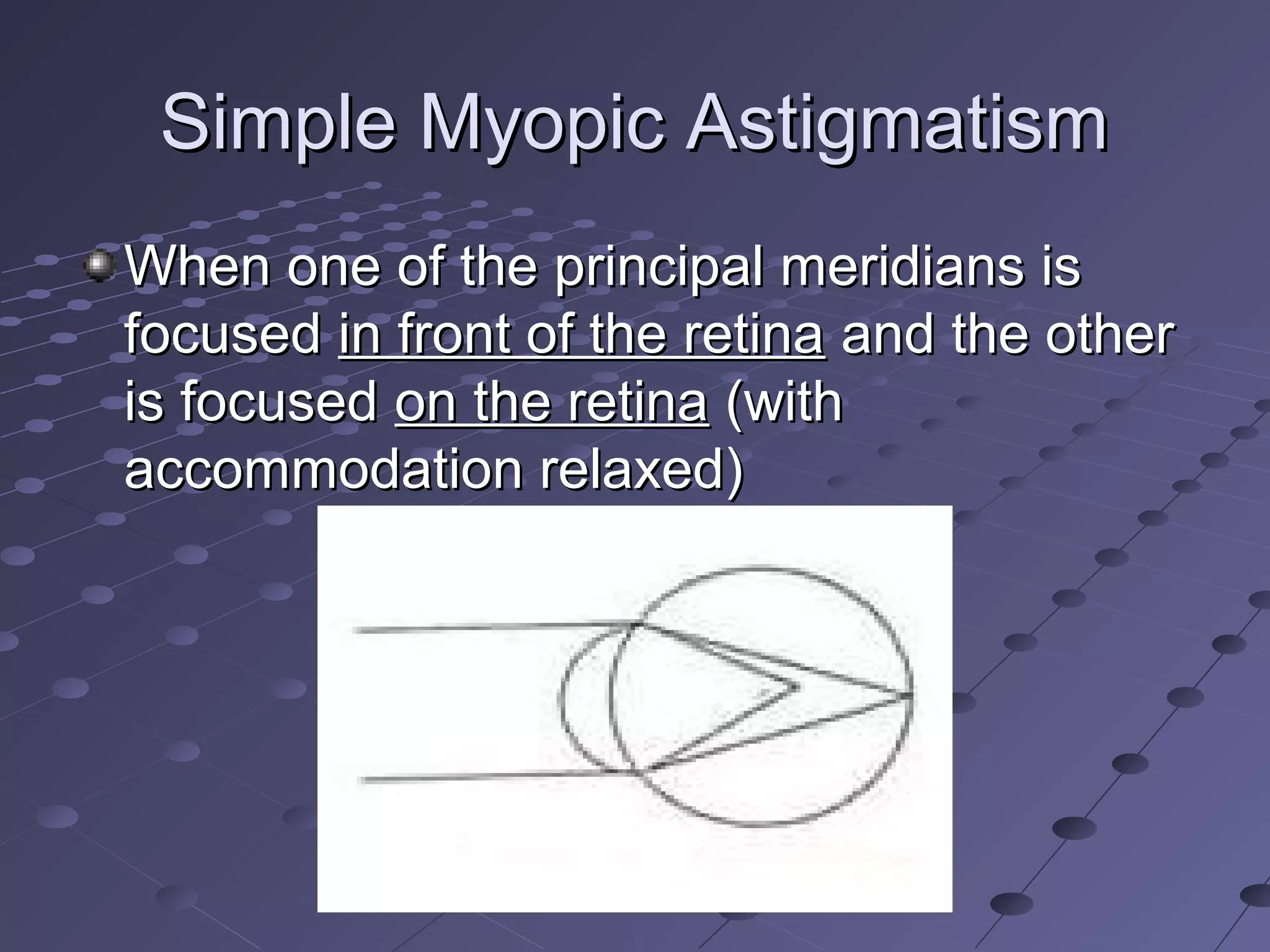 Astigmatism 2 | PPT