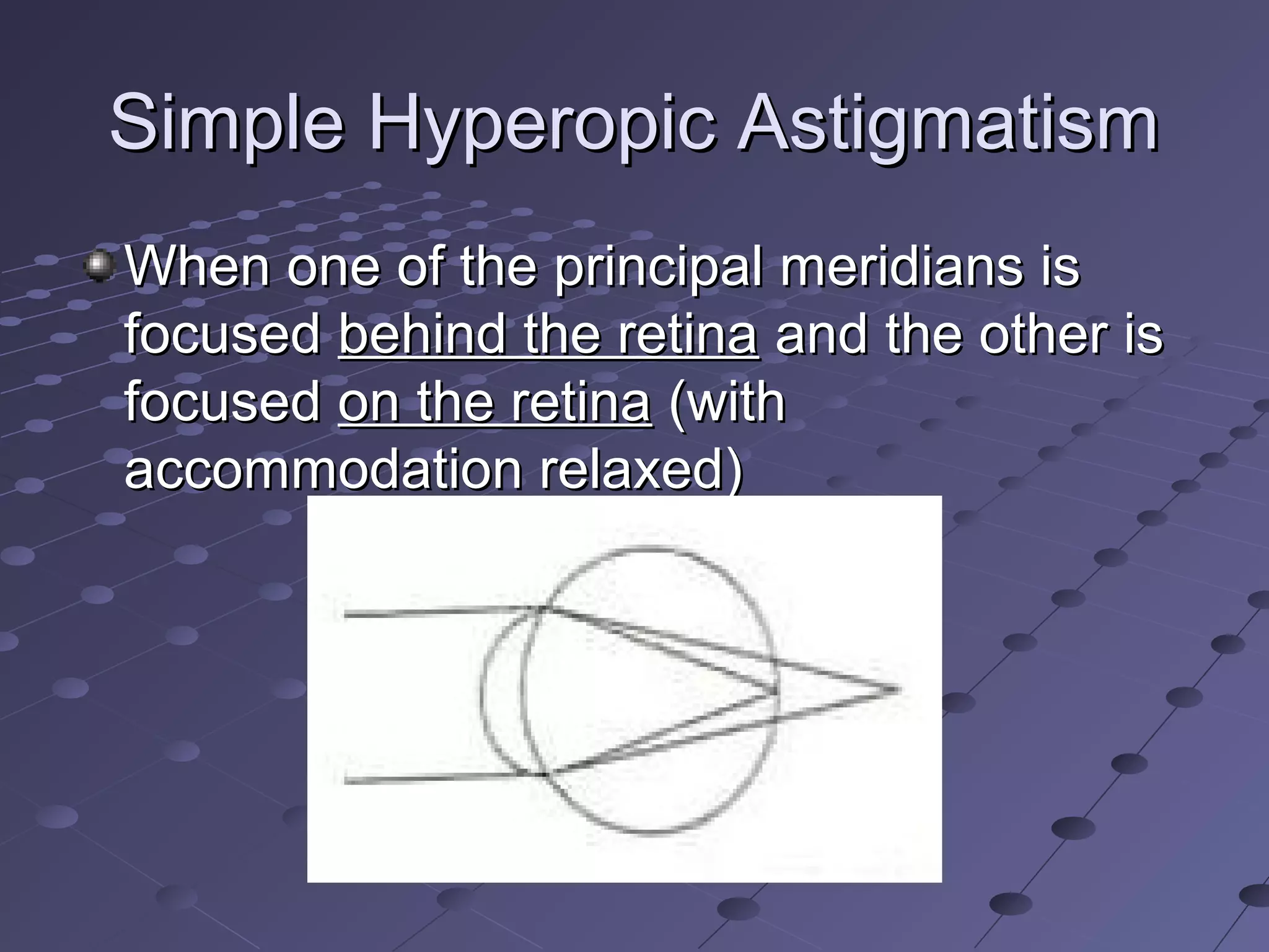Astigmatism 2 | PPT
