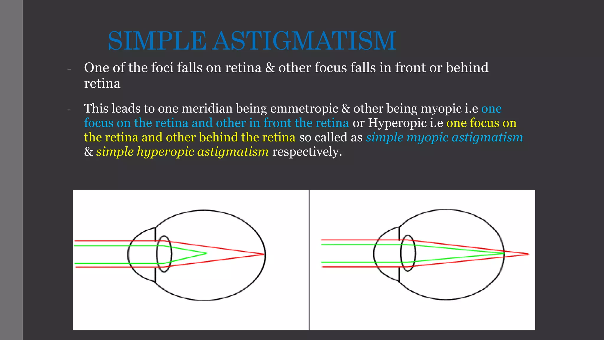 Astigmatism, anisometropia, anisekonia. | PPTX