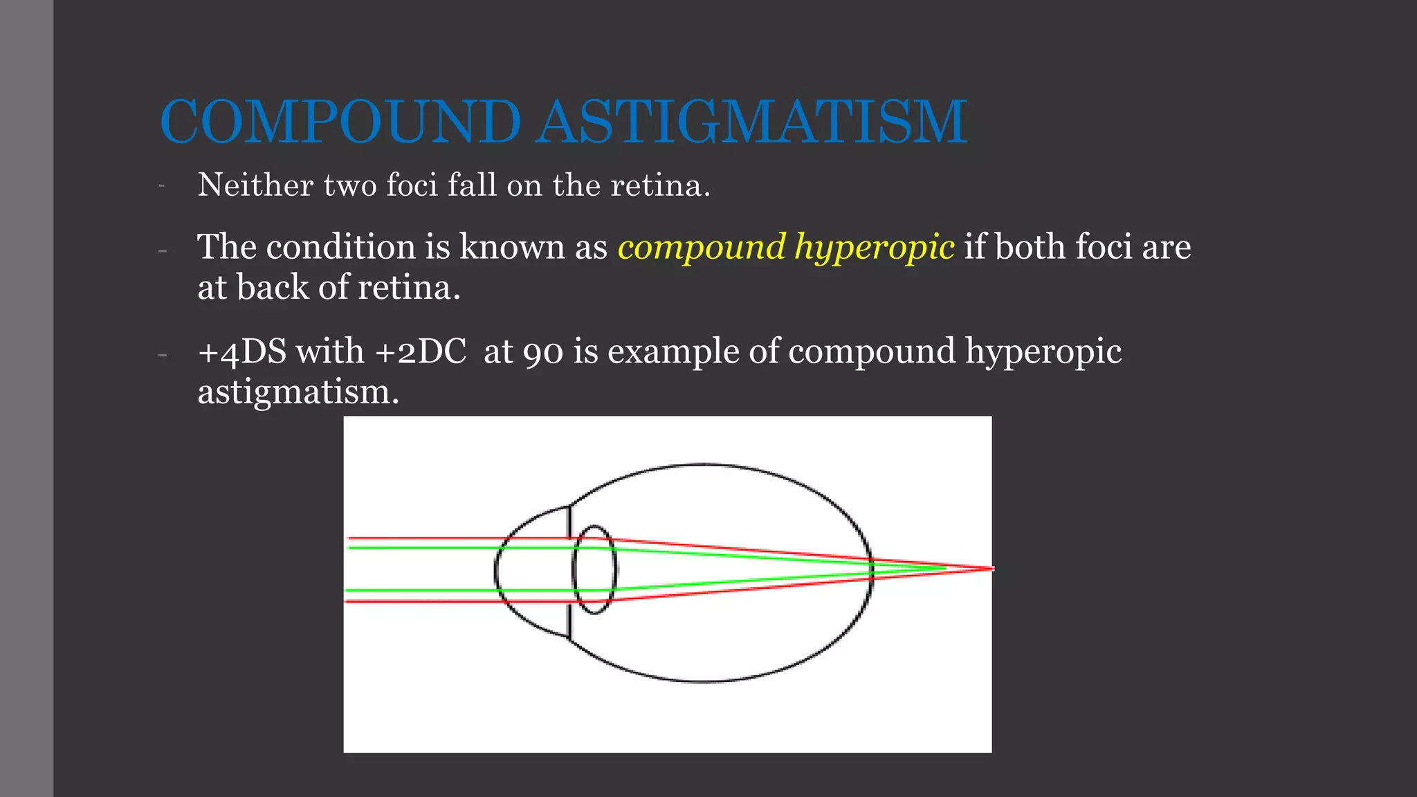 Astigmatism, anisometropia, anisekonia. | PPTX