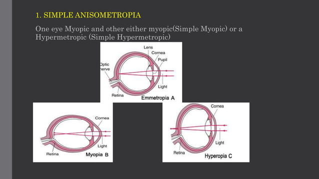Astigmatism, anisometropia, anisekonia. | PPTX