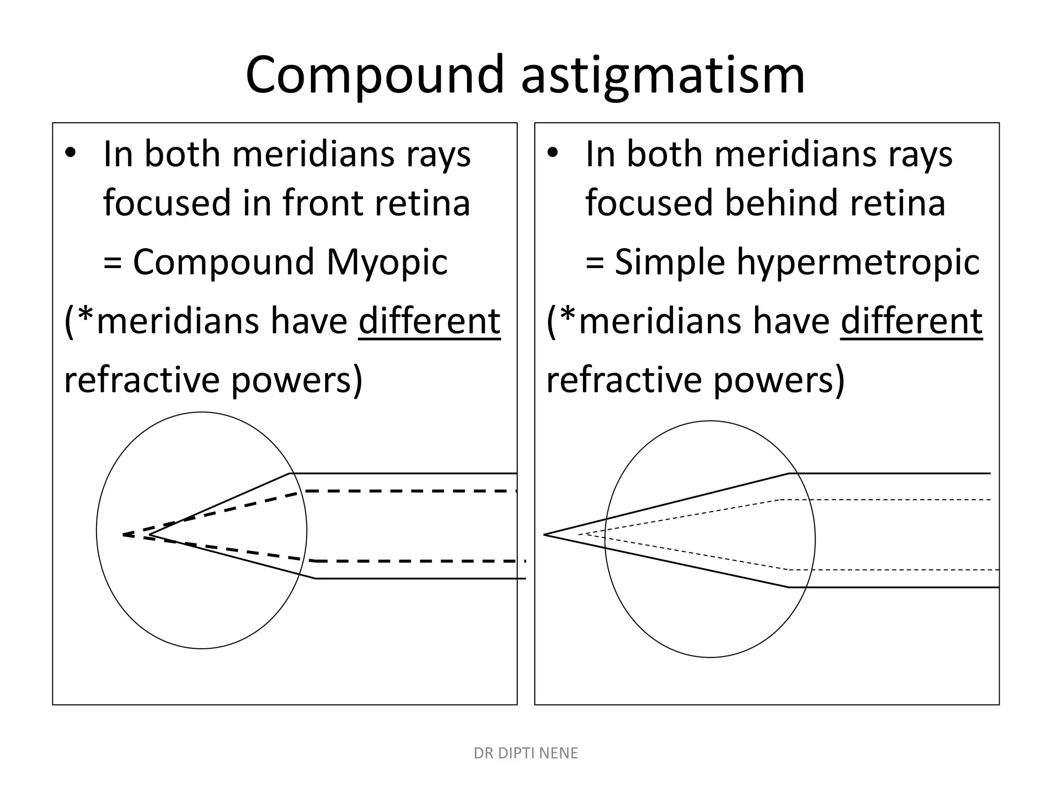 Astigmatism complete | PPTX