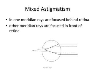 Astigmatism complete | PPTX